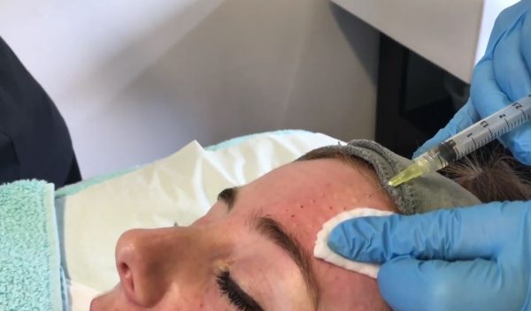 Mesotherapy | Advanced Treatments | Treatments – Revival Skin & Beauty
